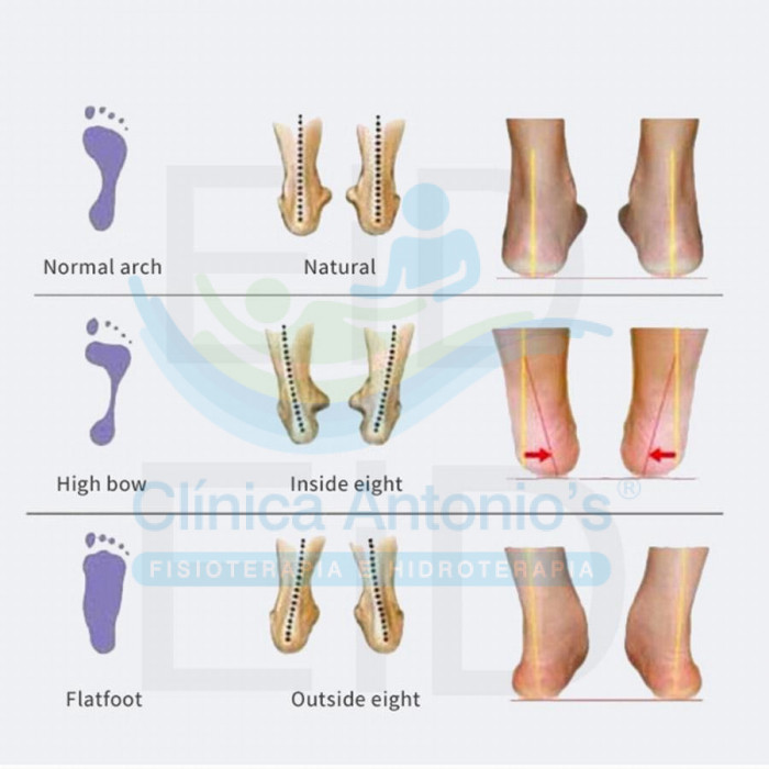 Pé Plano e Pé Cavo - Clínica Antonio's