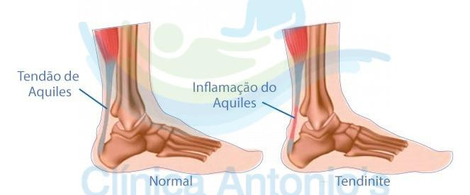 Dor Na Tendinopatia De Aquiles